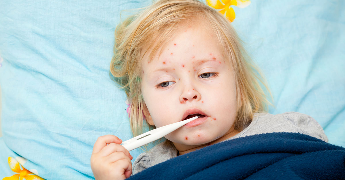 Five facts to know about measles - Children's National